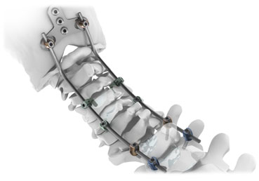 Perfix Iliac Screw™ (by U&I CORPORATION)