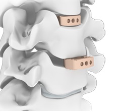 Velofix™ PEEK Cervical (by U&I CORPORATION)